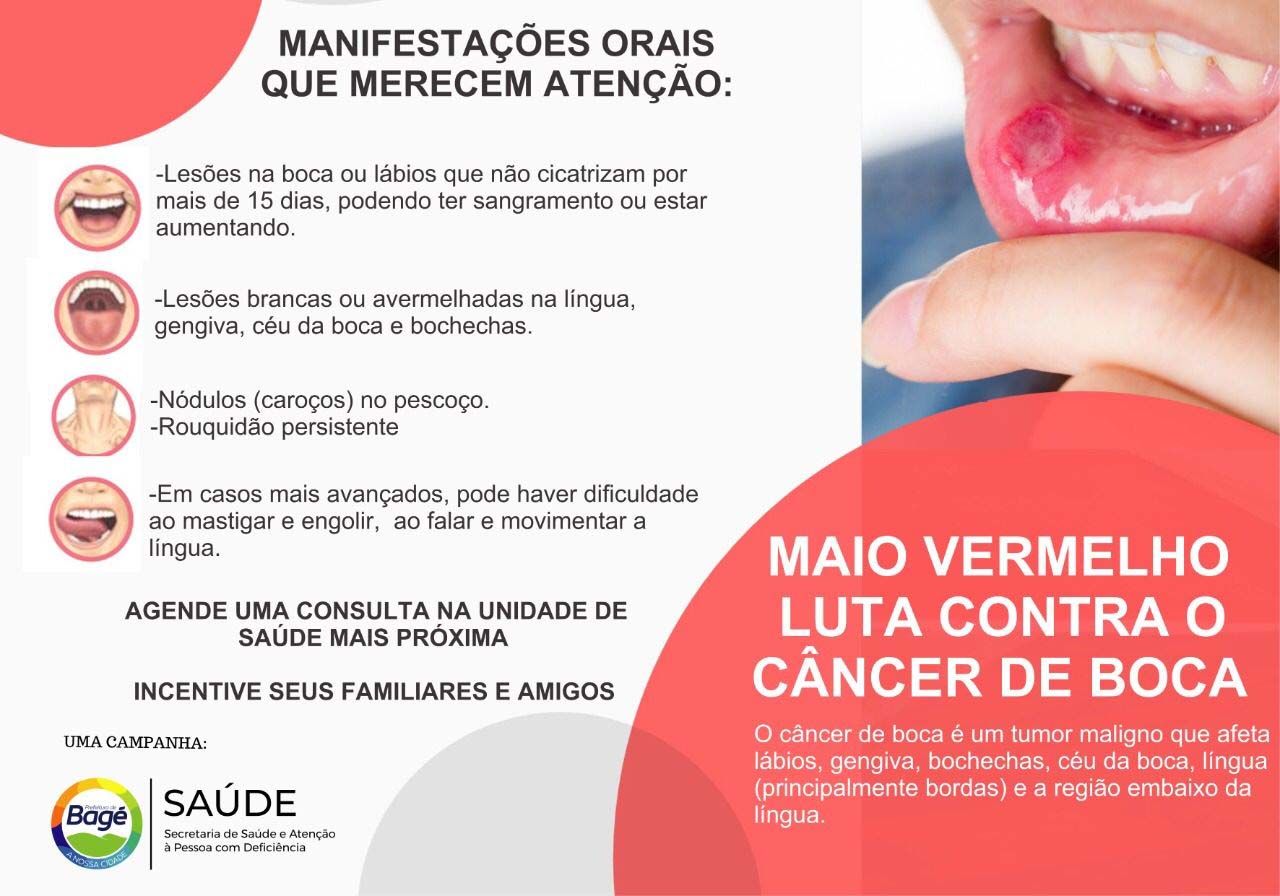 Câncer de boca | Editoria Social | Jornal Minuano | O jornal que Bagé ...